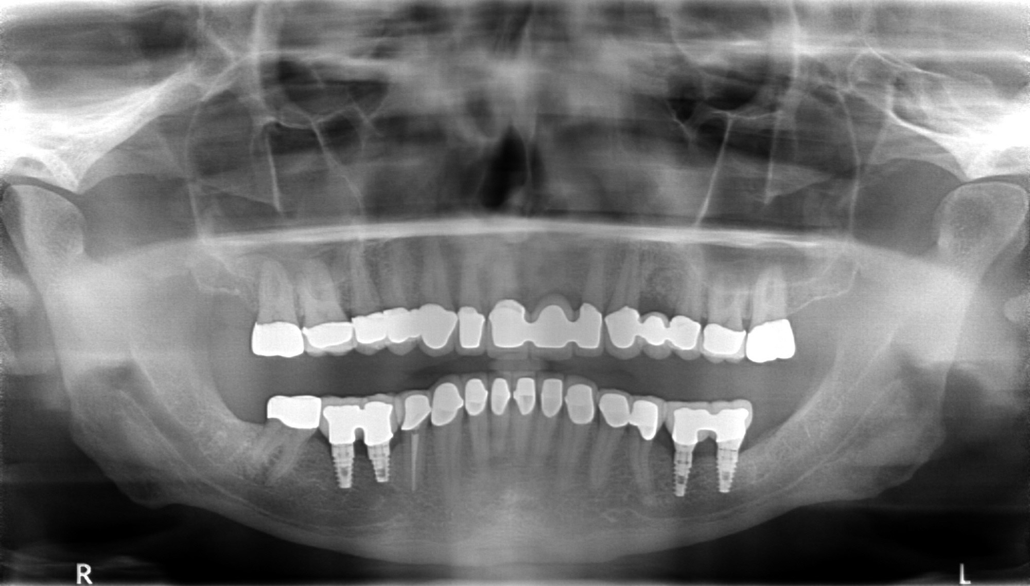 Care and Maintenance for Teeth and Implants | Dr. Emily Batson